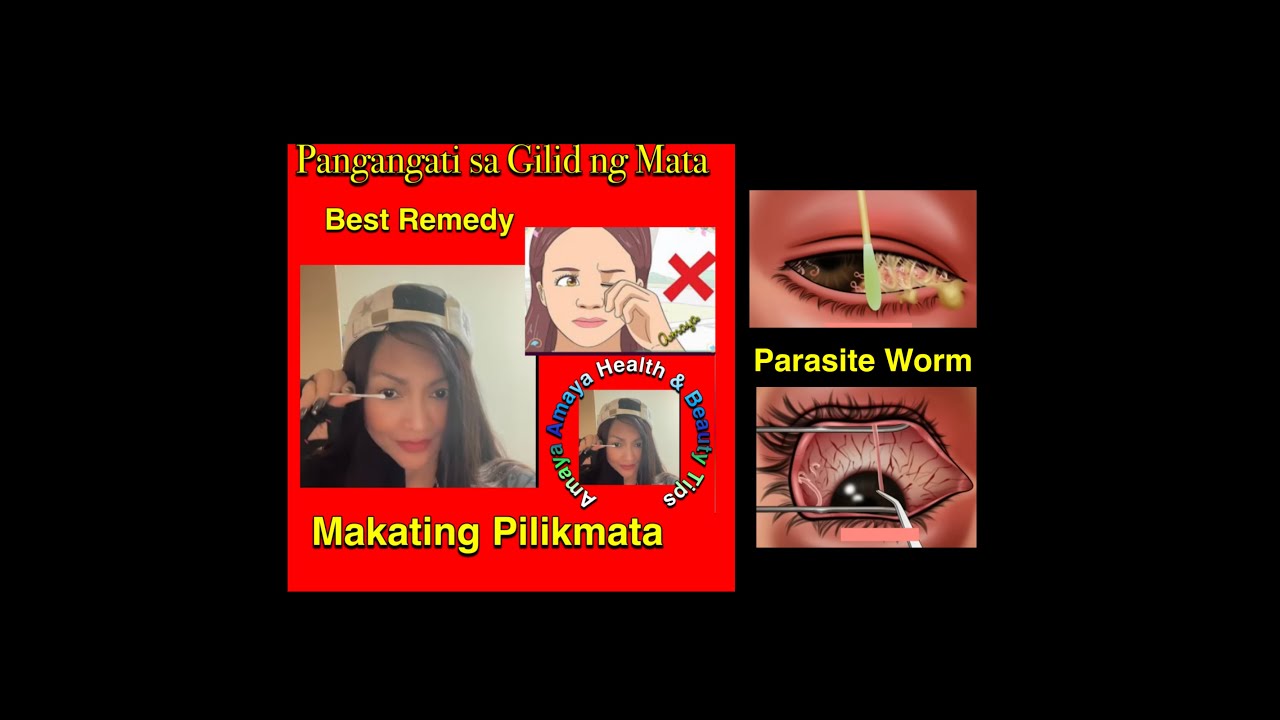 Best Remedy sa Pangangati ng gilid ng Mata - YouTube