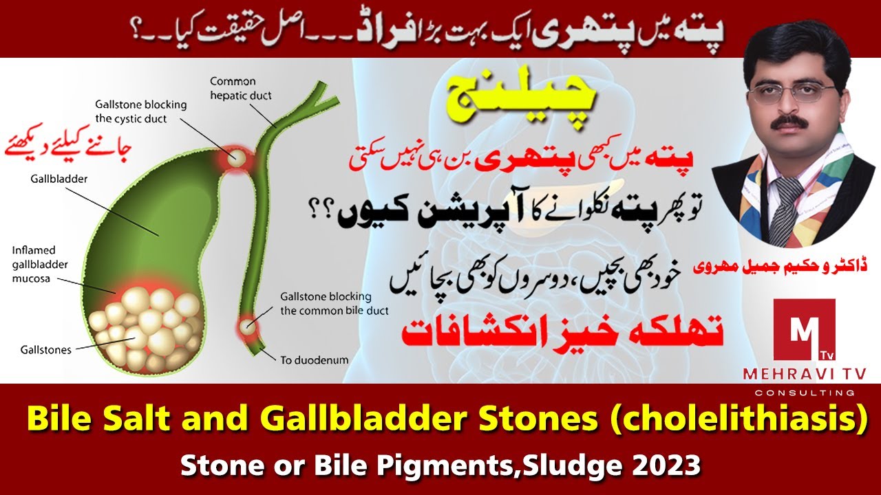 Bile salt and gallbladder stone (Cholelithiasis)پتہ میں پتھری بن ہی ...