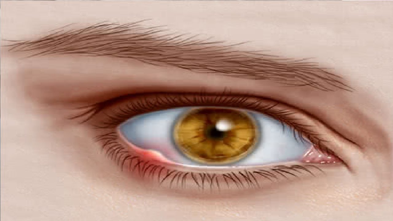 how to get rid of a stye on your top eyelid - YouTube