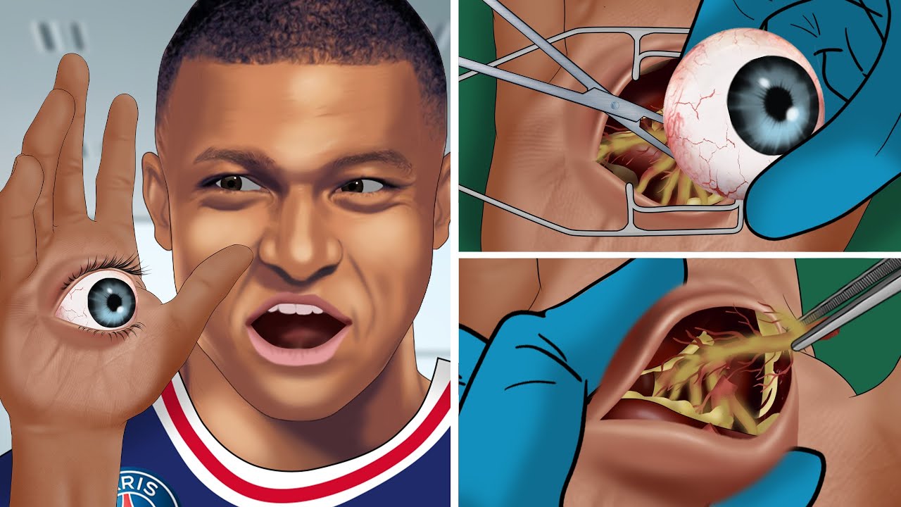 ASMR Help Kylian Mbappé remove the extra eye from his palm | Treatment ...