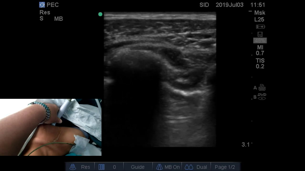 Ultrasound screening of PEC BLOCKS 2 - YouTube