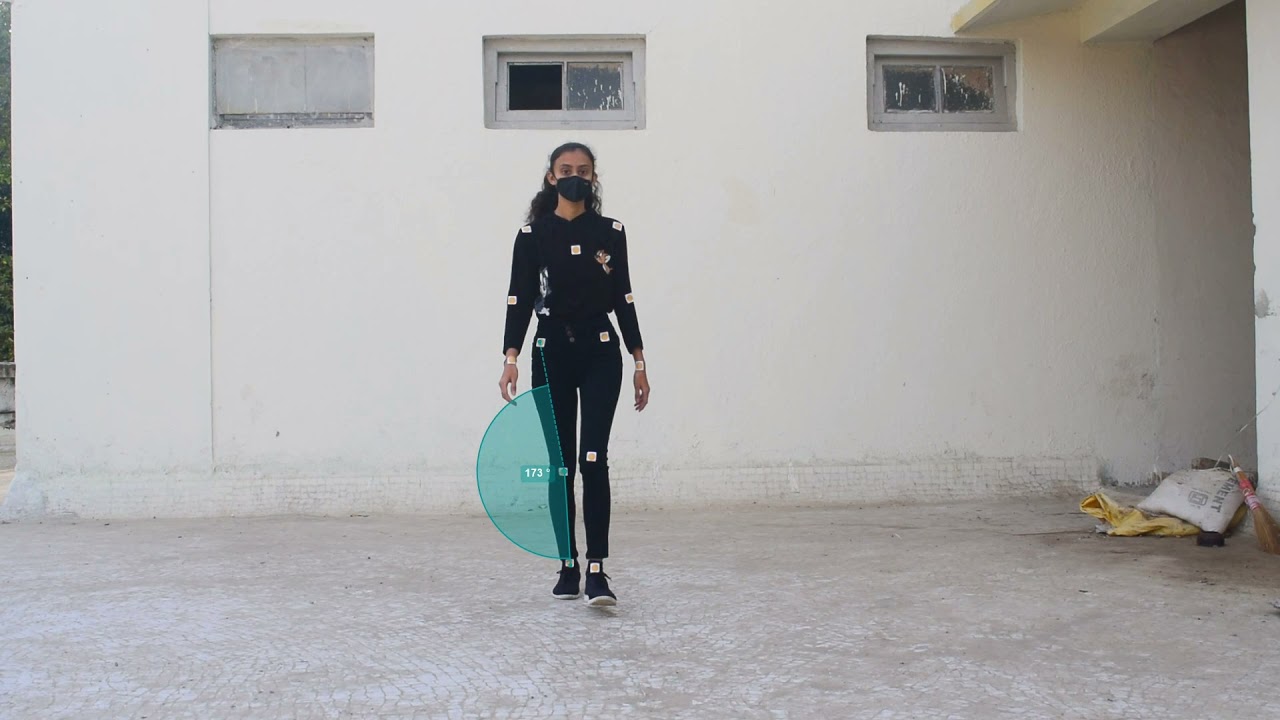 Gait Physiological Valgus - YouTube