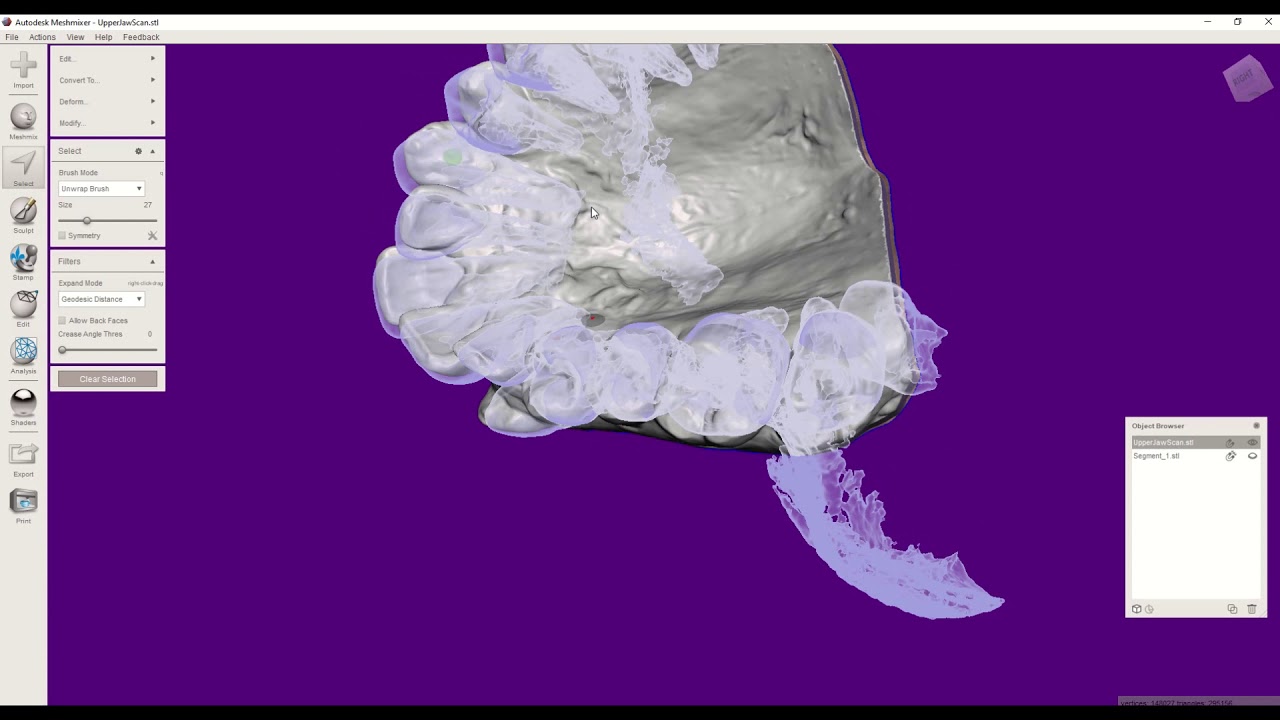 Alineación del CBCT (DICOM) y Escaneado Dental (STL) con Meshmixer ...