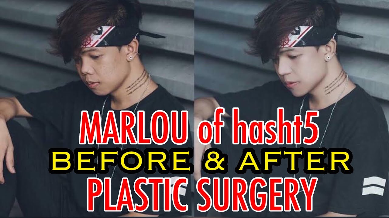 MARLOU of hasht5 Nagpa-Plastic Surgery, Changes Name to Xander Ford ...