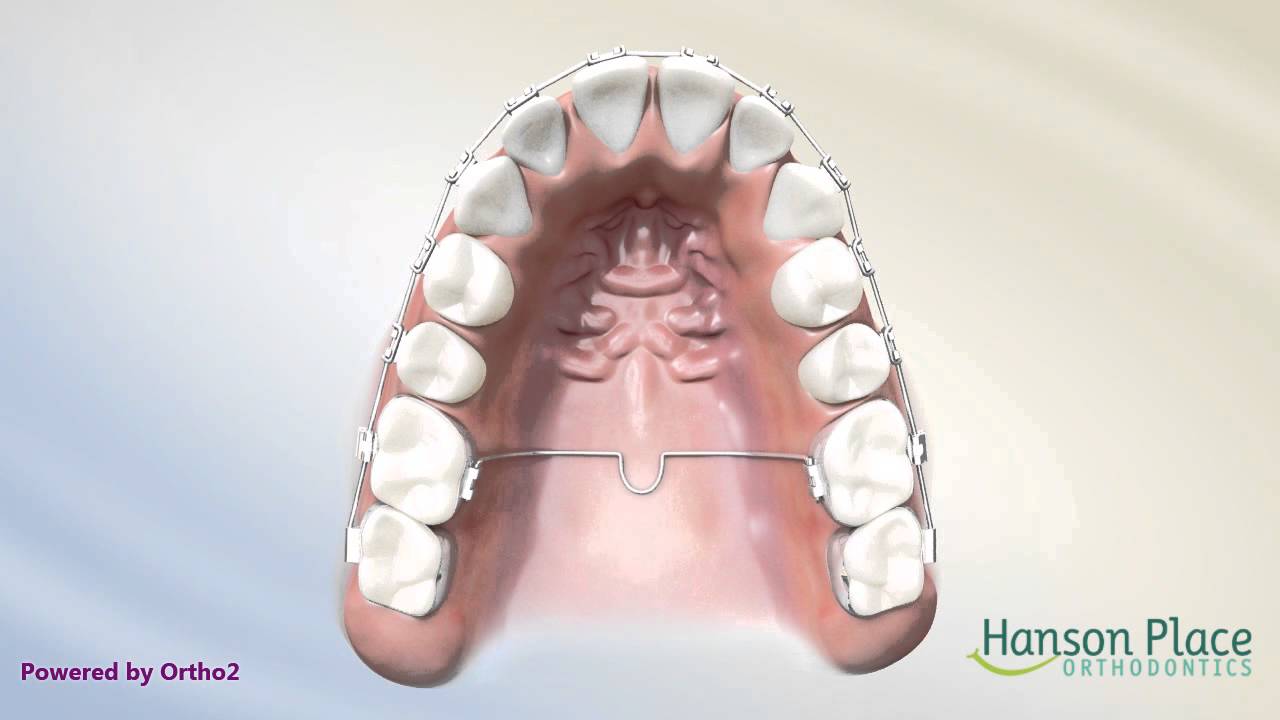 Trans Palatal Arch - YouTube