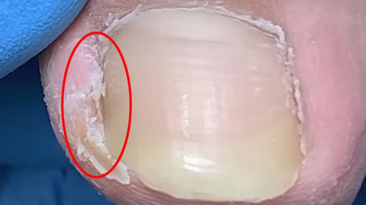 Extra thick dead skin stuck inside toes, dig it all out!【Xue Yidao ...