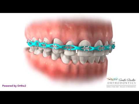 When Do They Put Power Chains On Braces