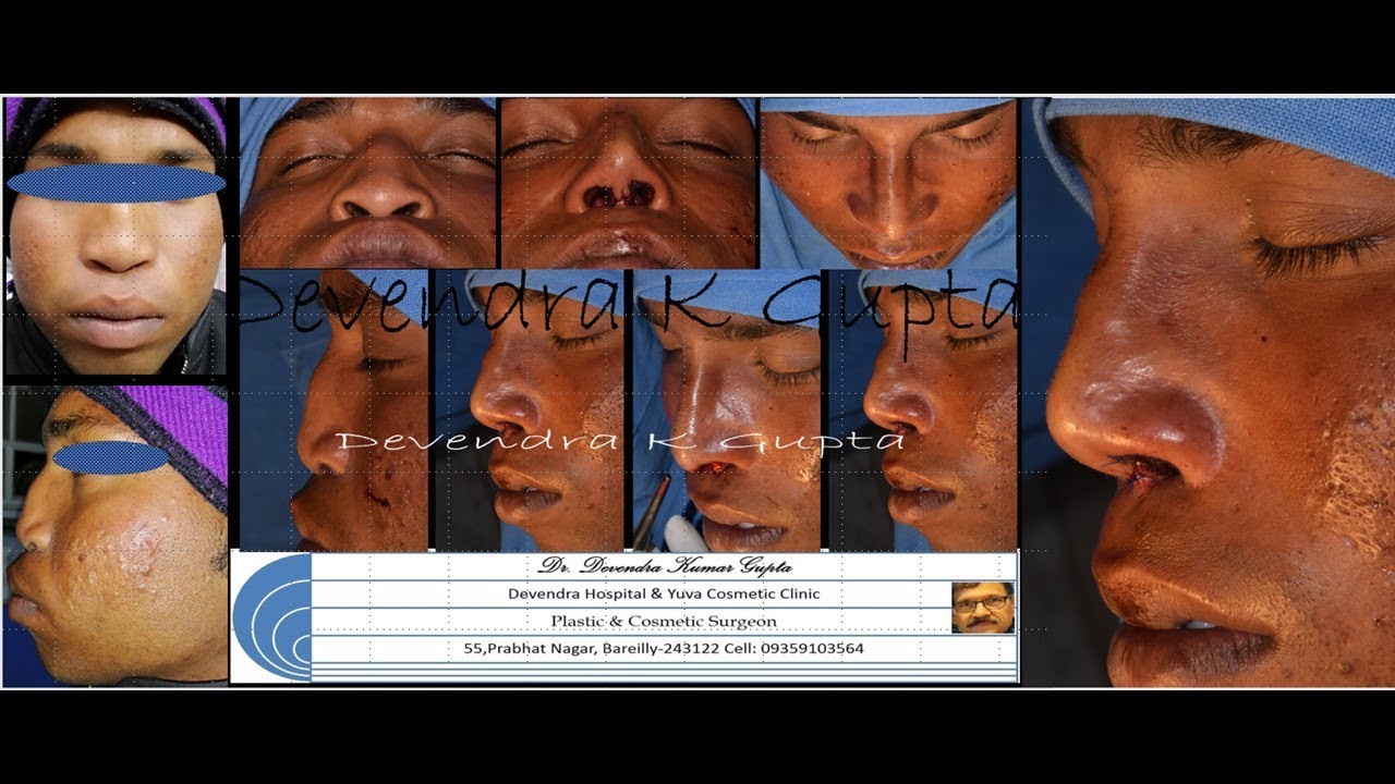 Binder Syndrome (maxilla-facial dysplasia) - YouTube