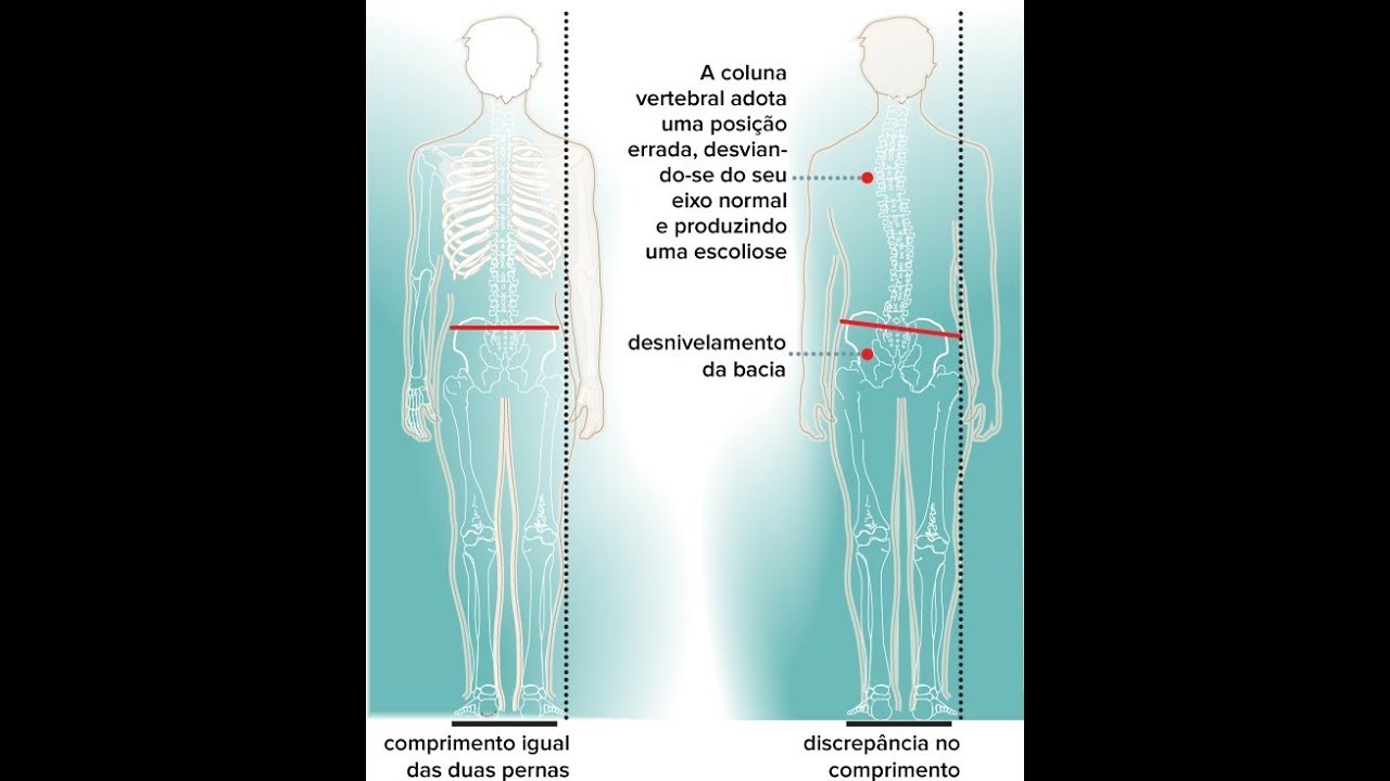 Avaliação do Comprimento das Pernas (Real e Aparente) Clínica de ...