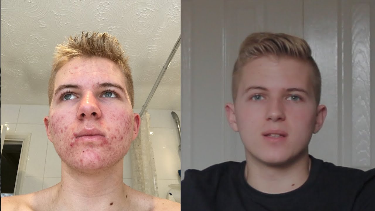 How I Got Rid of My Acne | My Accutane/Roaccutane Experience - YouTube