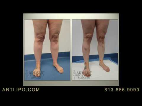 Lipedema Surgery | Liposuction | Lipo 360 Cankles & Knees, Ankles ...