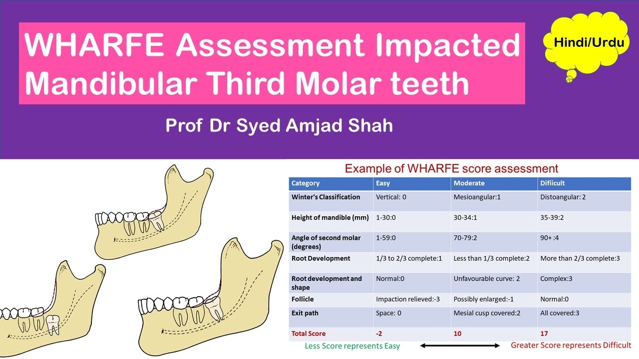 WHARFE Assessment Impacted Mandibular Third Molar teeth | Syed Amjad ...