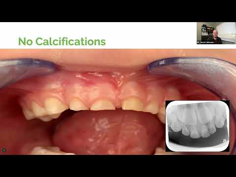 Mastering Primary Teeth Pulpotomies: Techniques and Best Practices for ...