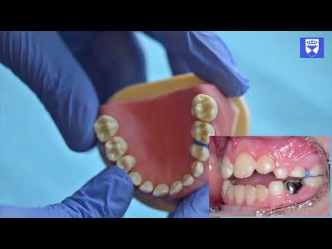 How To Remove Orthodontic Spacers
