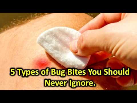 5 Types of Bug Bites You Should Never Ignore - YouTube