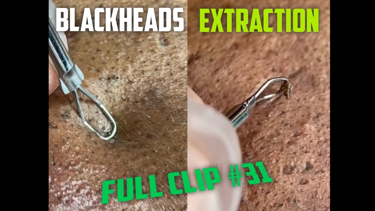 BLACKHEADS EXTRACTION NEW | #31 | BLACKHEADS EXTRACTION THIS WEEK - YouTube