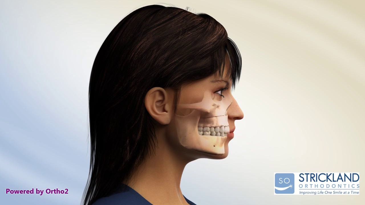 Maxillary Jaw Surgery Impaction SO - YouTube