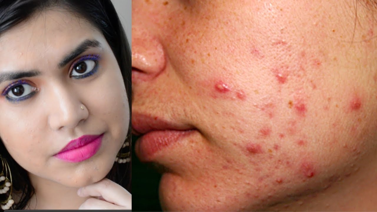 My Real Acne story Hormonal acne skin Problems Solutions Depression ...