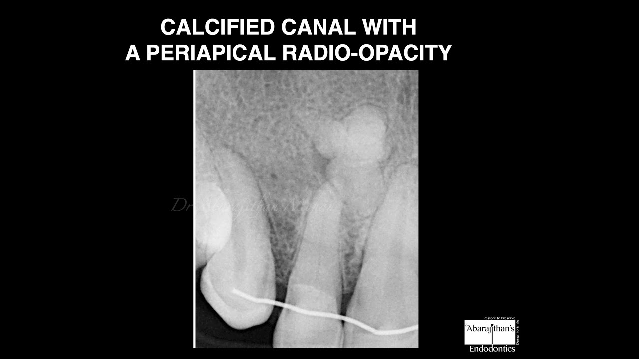 CALCIFIED CANAL WITH A MYSTERIOUS PERIAPICAL RADIO-OPACITY IN A ...