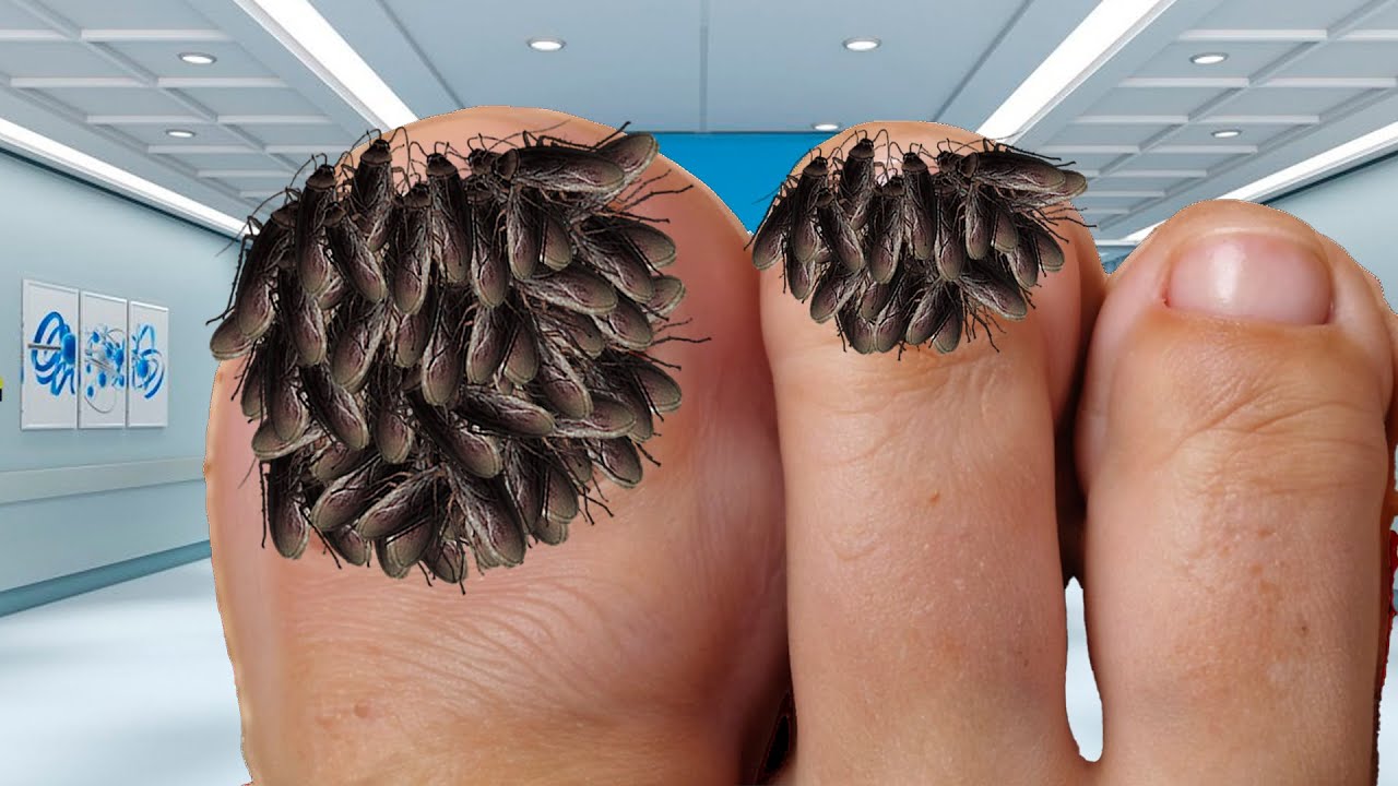 ASMR Toe Treatment Remove Ticks & Worm Infection | ASMR 2d Severely loosing Toe treatment - YouTube