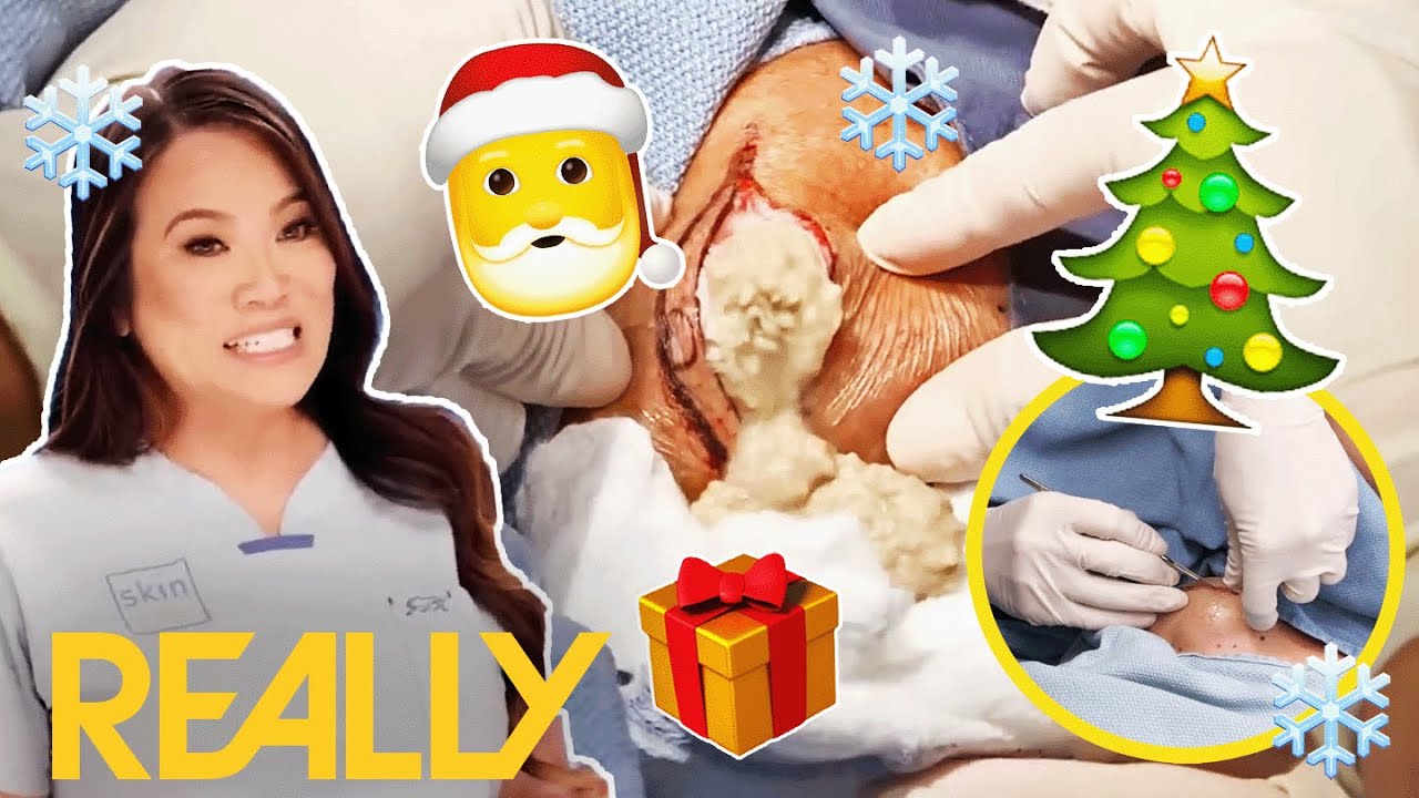 Dr Lee's MOST INTENSE Cyst and Bump Removals With CHRISTMAS MUSIC | Dr ...