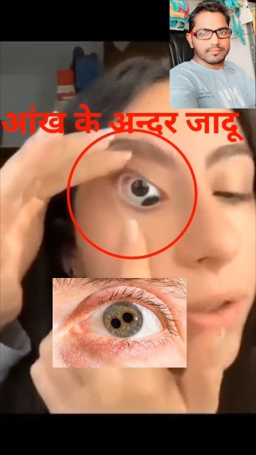 Polycoria #Multiple Pupils in One Eye #Shocking Eye #ConditionPolycoria ...