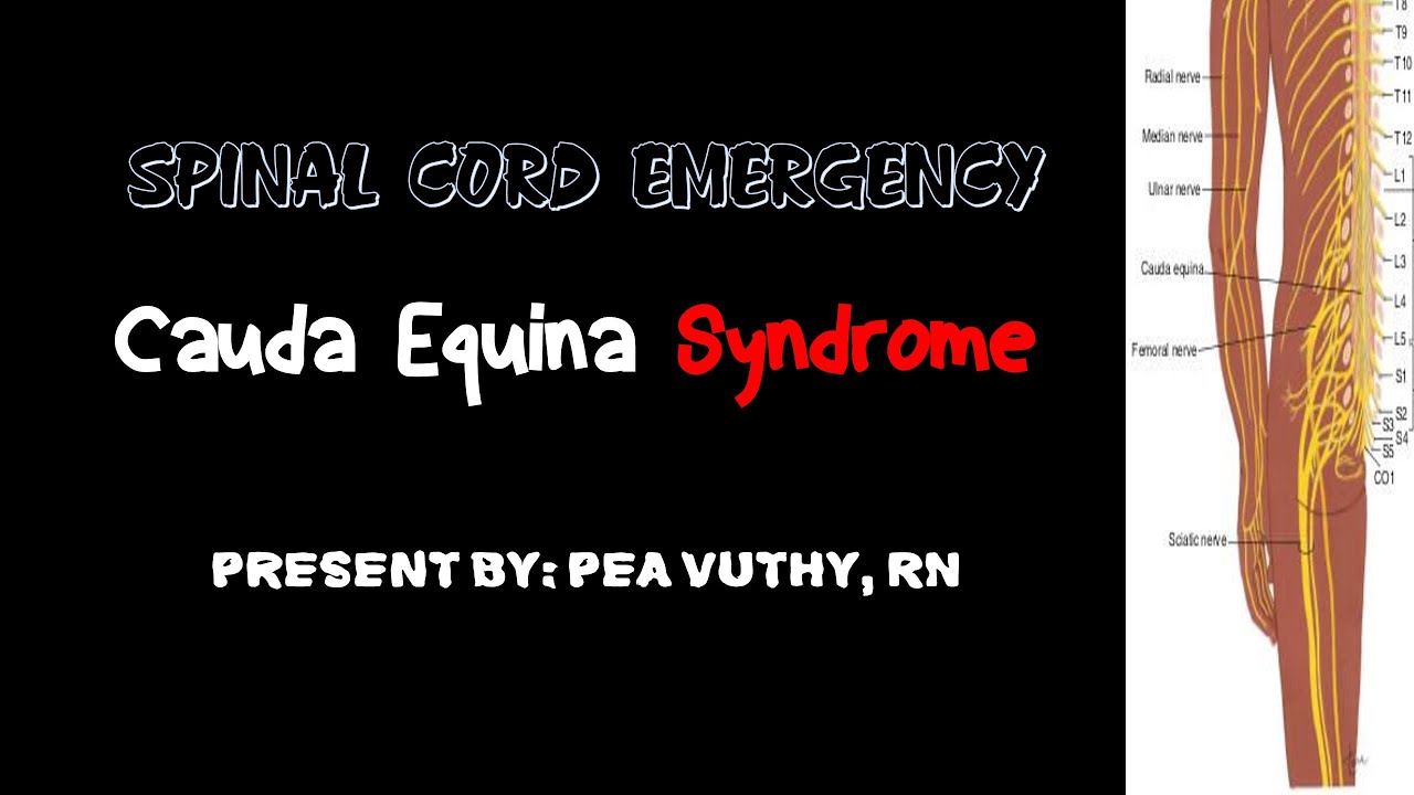 សញ្ញាបន្ទាន់នៃបញ្ហាកៀបសរសៃប្រសាទឆ្អឹងខ្នង - Cauda Equina Syndrome ...