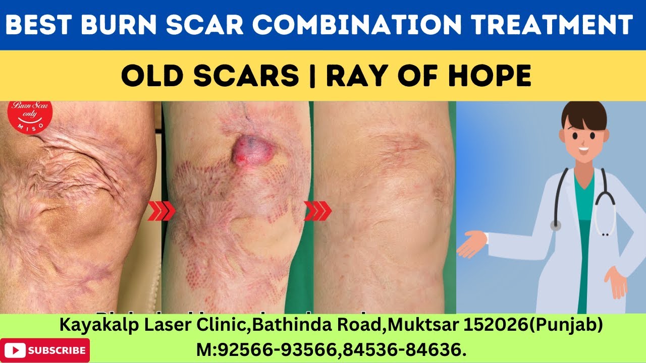 Best Burn Scar Combination Treatment | Old Scars | Ray of Hope ...