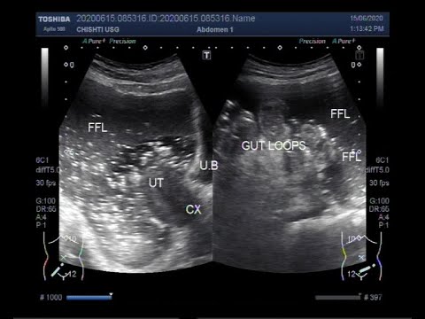 Ultrasound Video showing Intestinal Perforation. - YouTube