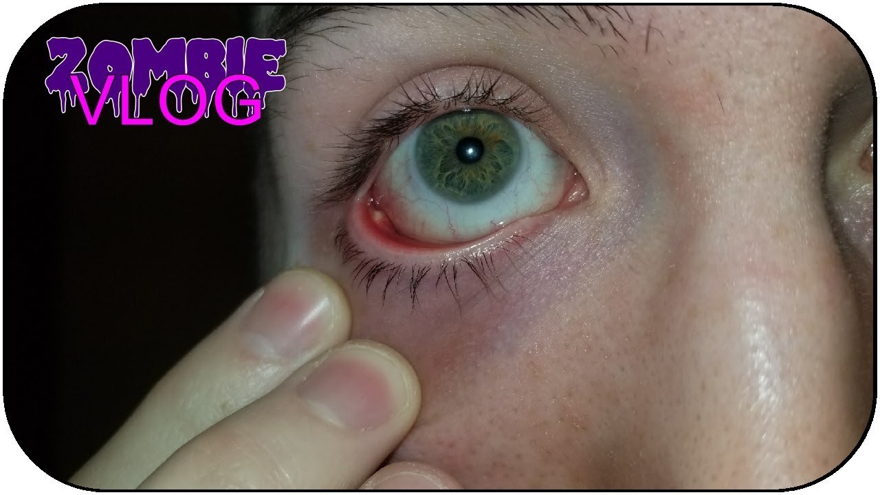 SORRY THIS VLOG IS DISGUSTING (I Ruptured My Eye Cyst) - YouTube