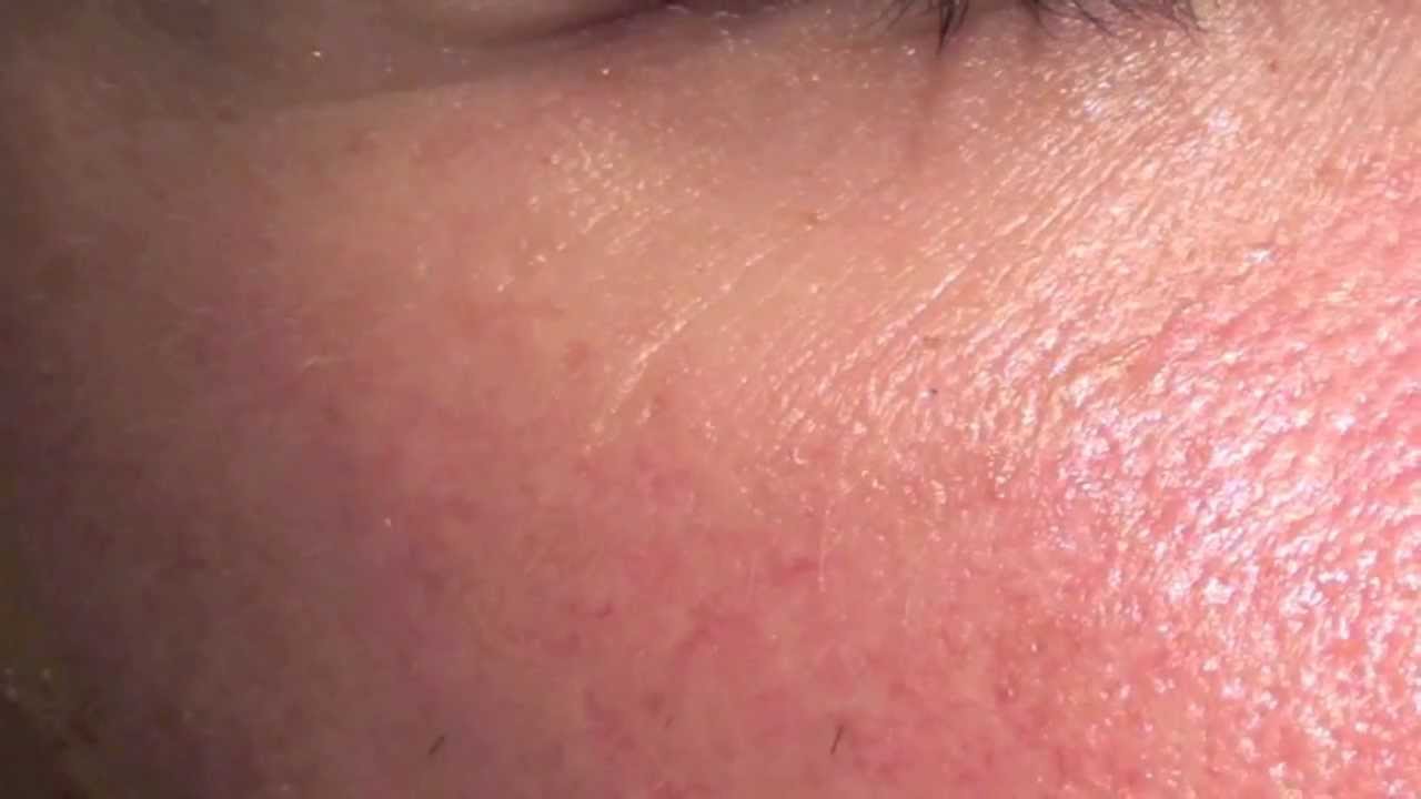 RENEW ME® Serum Effectiveness Demonstration FACEROBICS® - YouTube