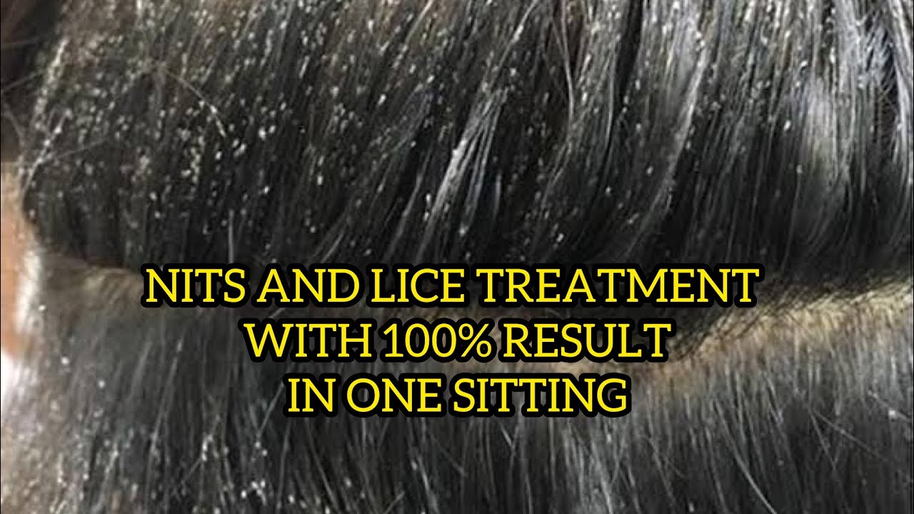 Nits & lice treatment just 2hrs ! One sitting only 💯 result!! - YouTube
