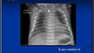Respiratory Distress Syndrome X Ray