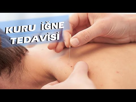 Doç.Dr. Habib Bostan - KURU İĞNE TEDAVİSİ NEDİR? ( IMS TEDAVİSİ )