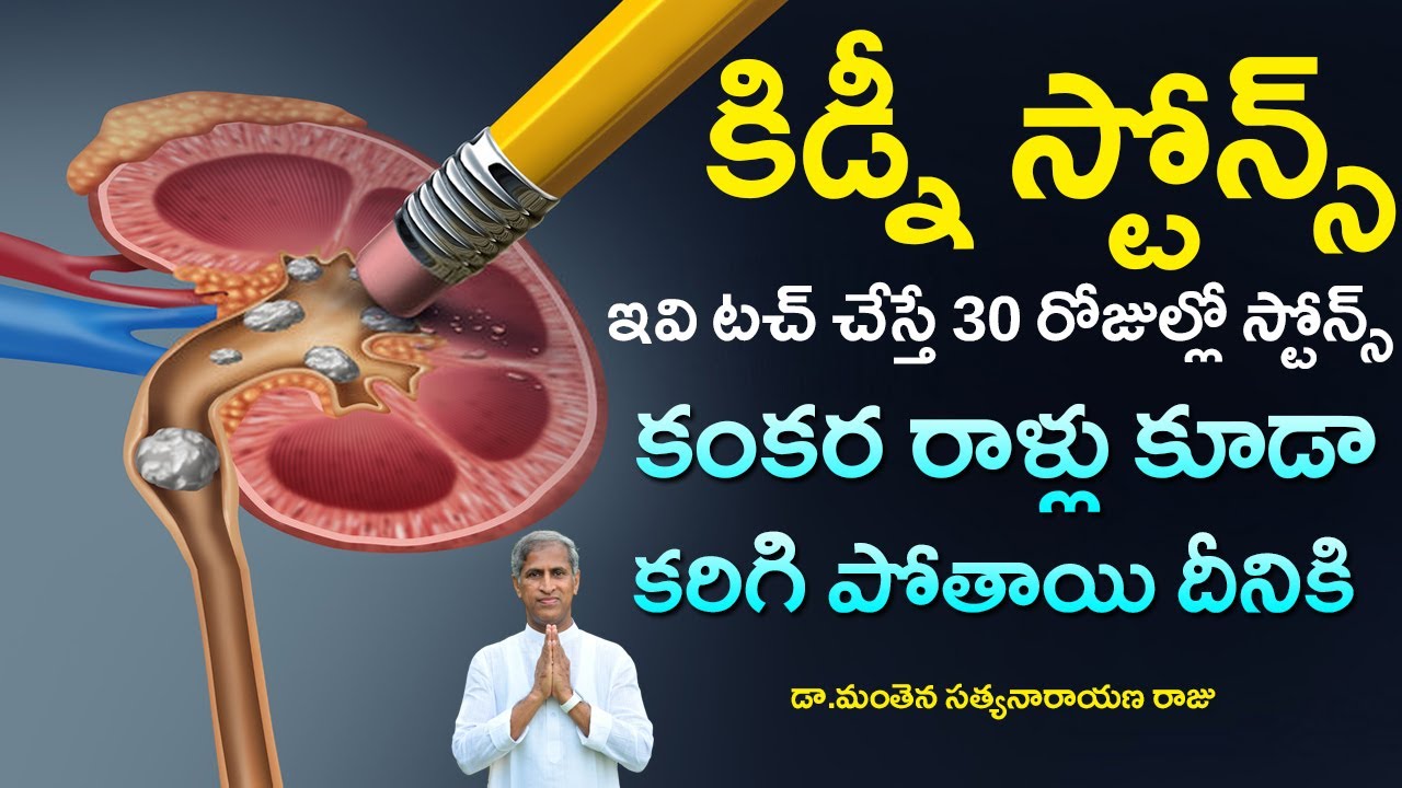 Kidney Stones | Multiple Kidney Stones Causes | Dr Manthena ...