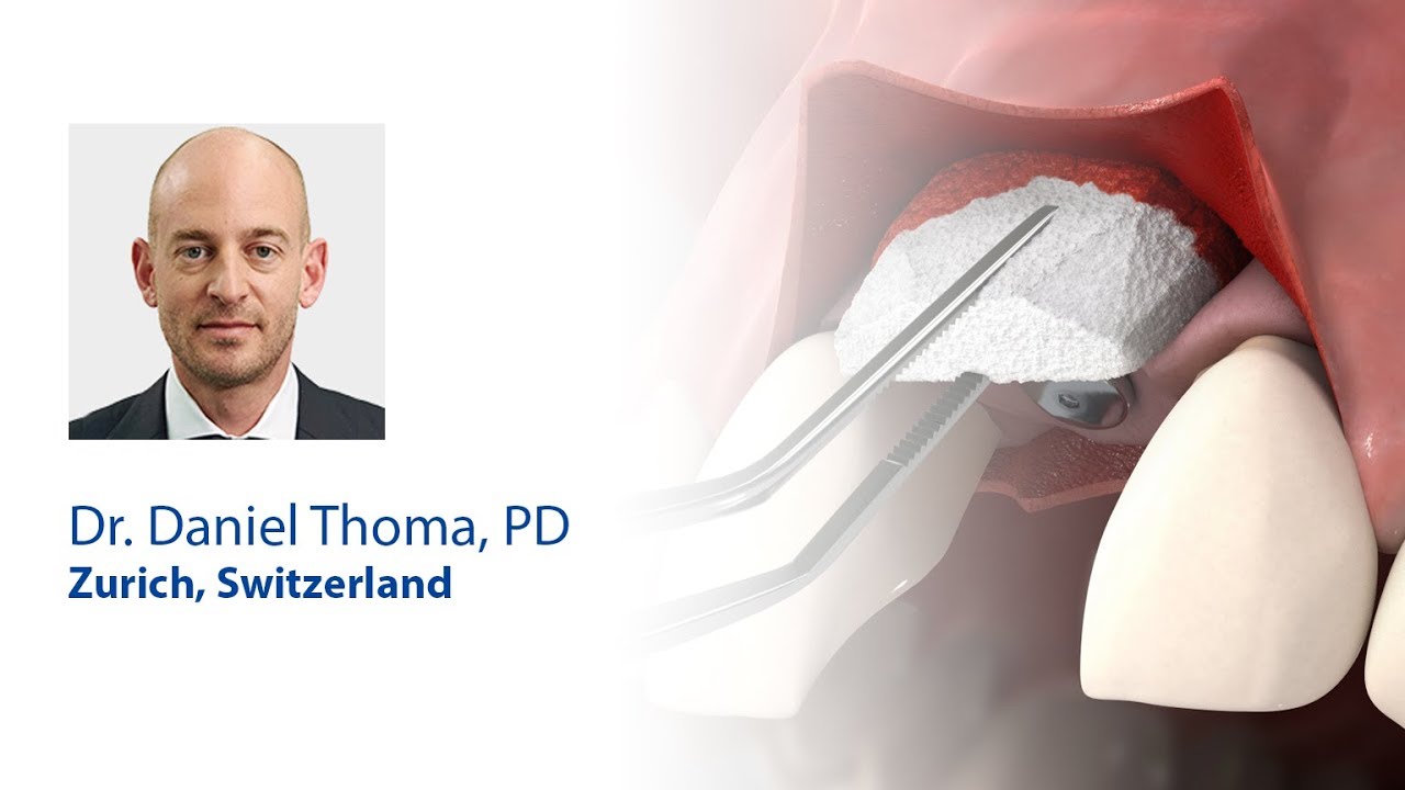 Case 2: Soft tissue augmentation around a dental implant - YouTube