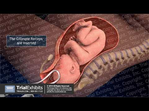 Delivery with Forceps