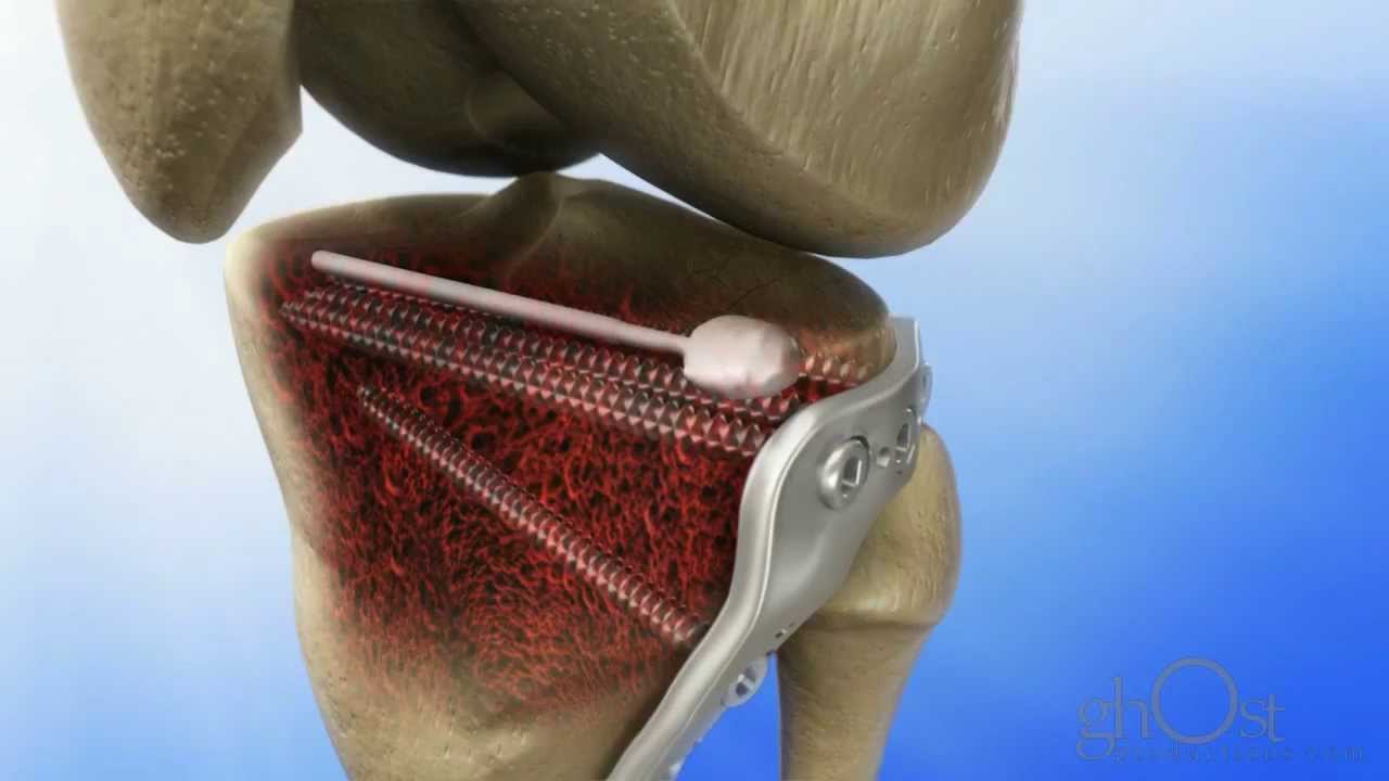 balloon osteoplasty - YouTube
