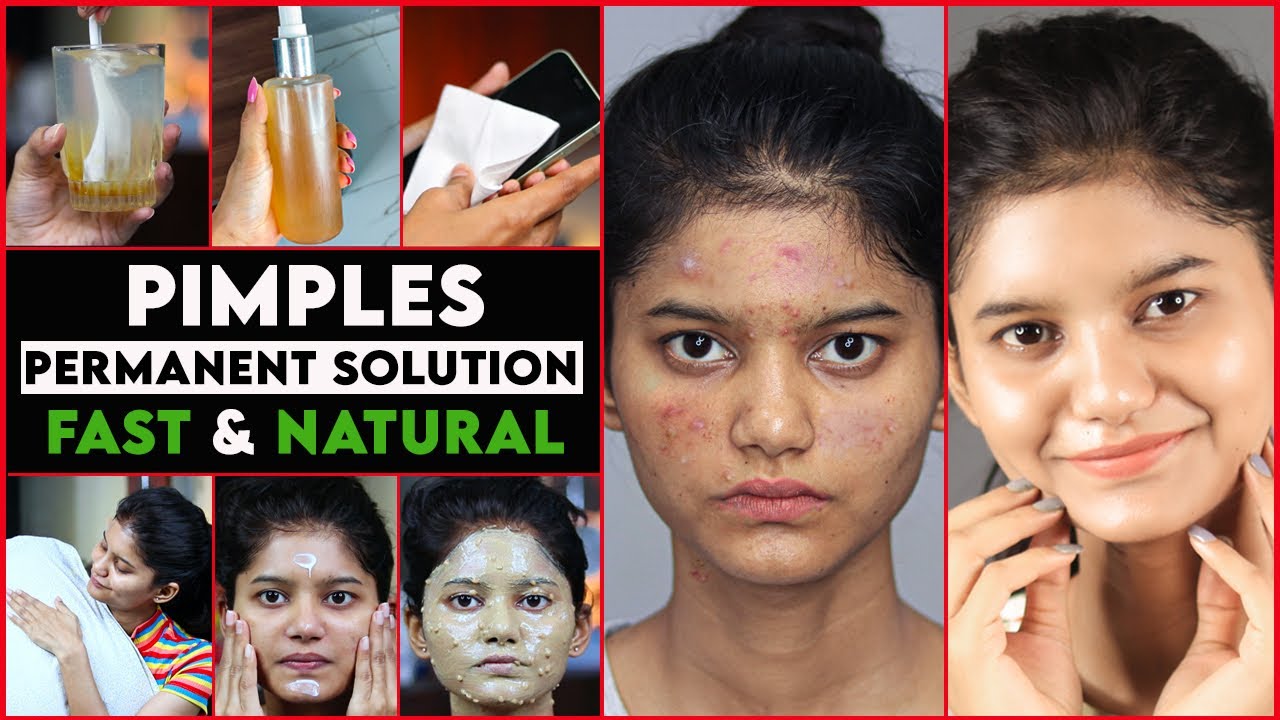 GET RID of PIMPLES NATURALLY | REMEDIES & PRECAUTIONS | PIMPLE ...