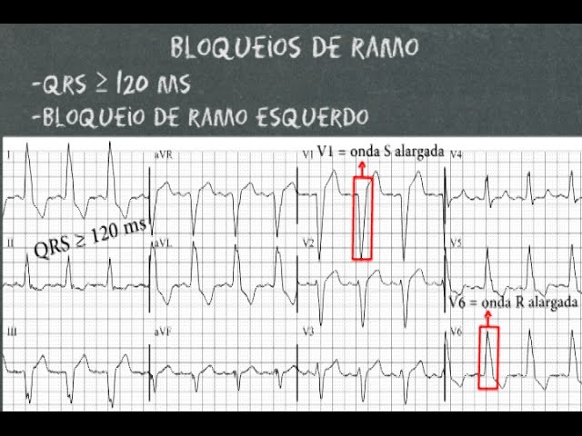 Bloqueio De Ramo Esquerdo Ecg Nesse Post Você Vai Aprender Quando