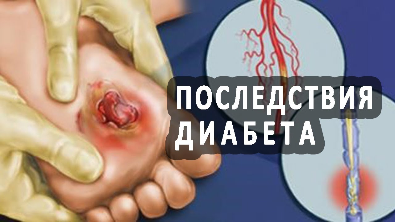Какие бывают последствия сахарного диабета Youtube