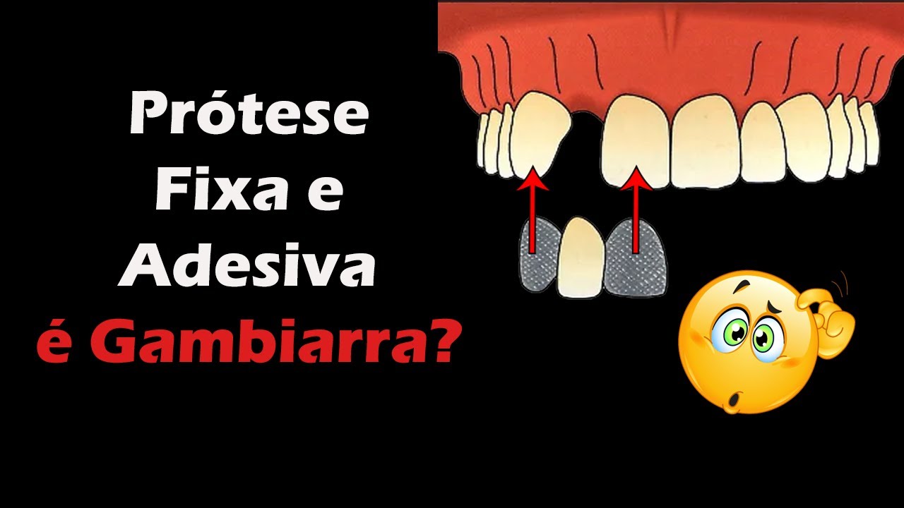 Prótese Fixa e Prótese Adesiva - Vale a Pena? Dentista Responde Dúvidas ...