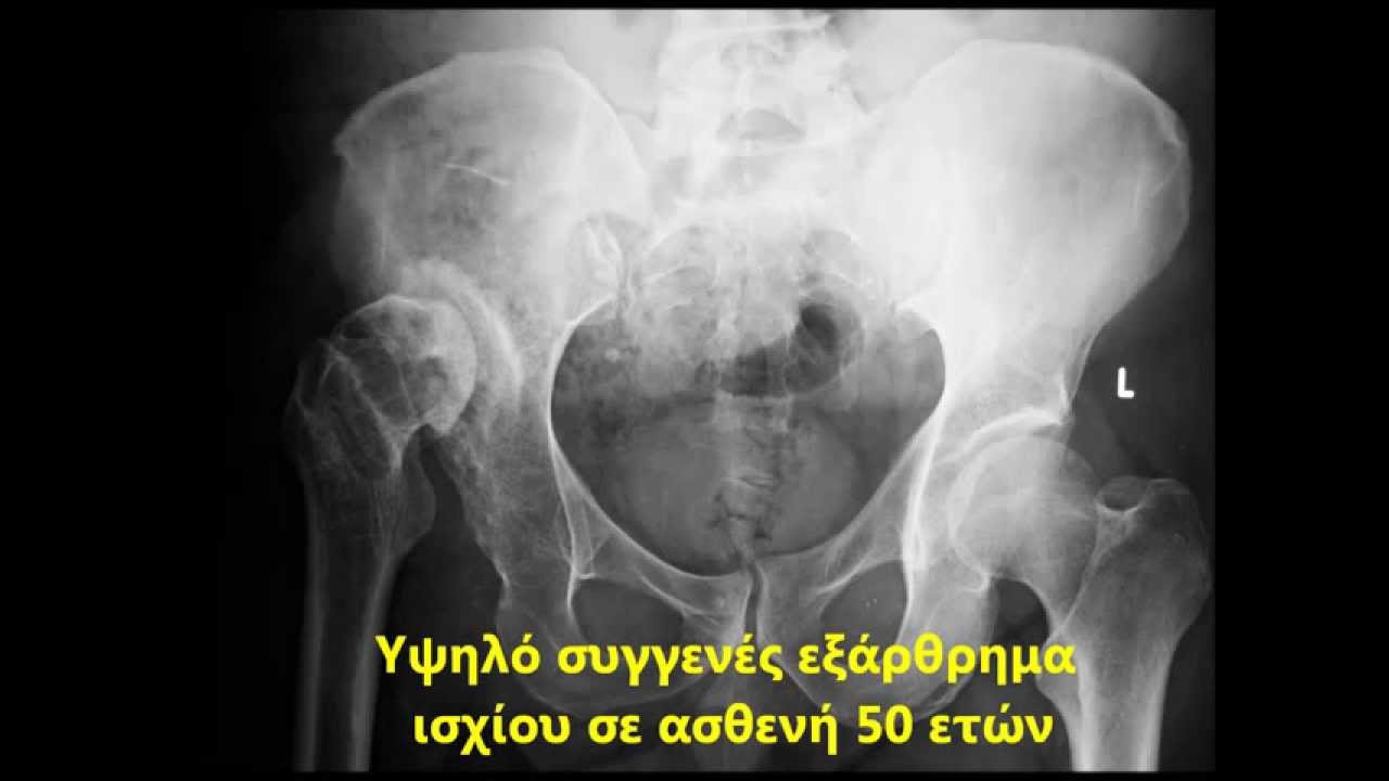 Άριστο κλινικό και ακτινολογικό αποτέλεσμα σε ασθενή με υψηλό εξάρθρημα ...