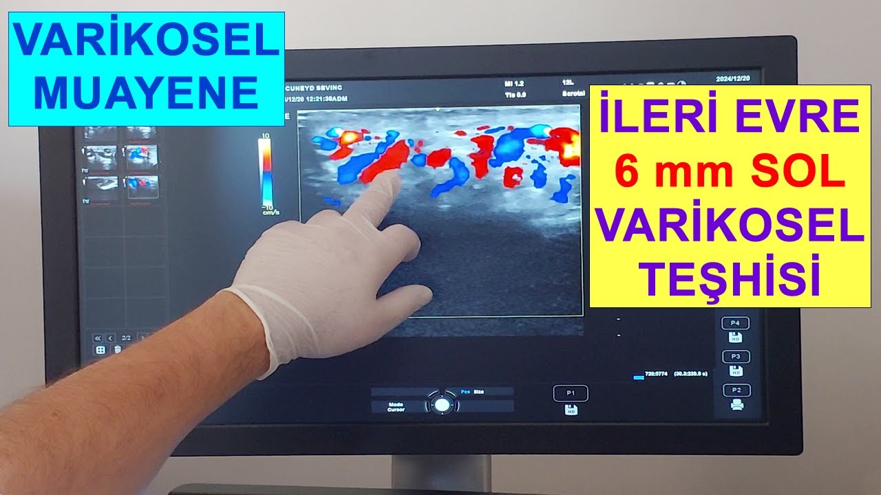 Varikosel Teşhisi: Sol Testiste 6 mm İleri Evre Varikosel - YouTube