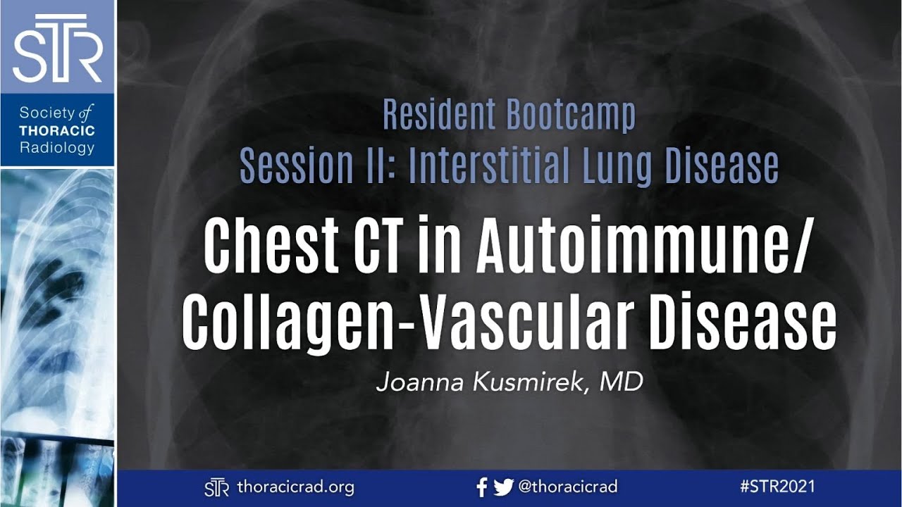 Chest CT in Autoimmune/Collagen Vascular Disease - YouTube