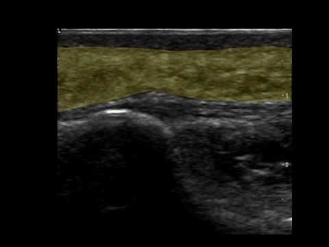 Musculoskeletal Ultrasound: Foot 1: plantar longitudinal scan - YouTube