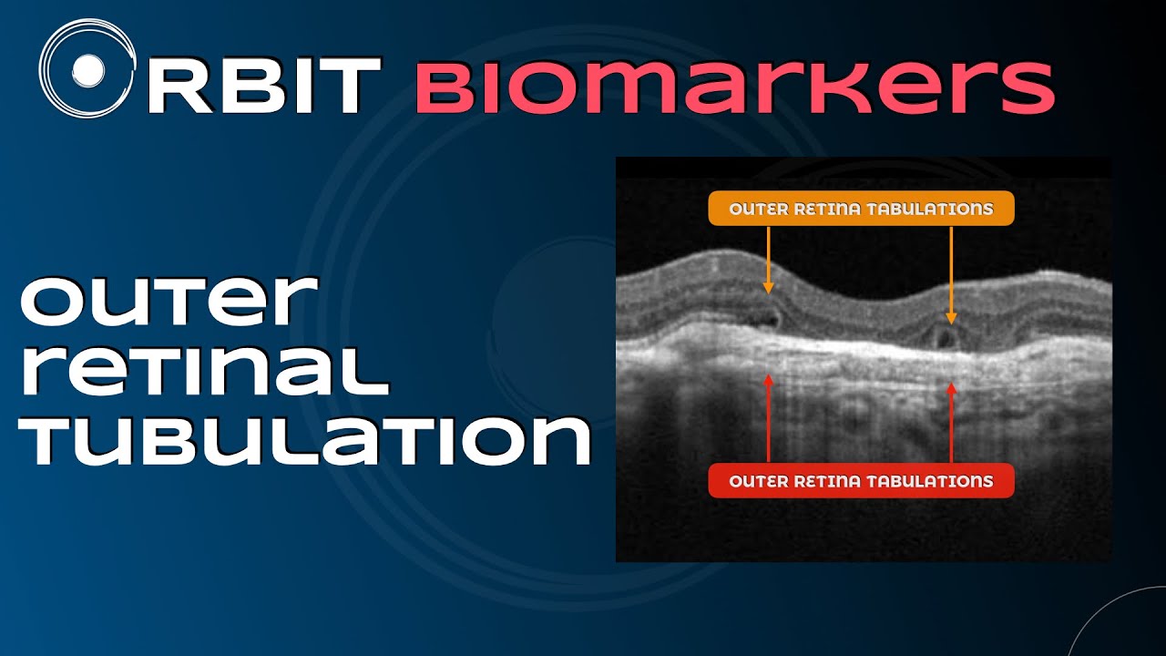 Tubulação retiniana externa - Outer retinal tubulation - ORT - YouTube
