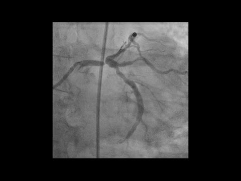 Left main PCI for distal lesion with caliber mismatch - YouTube