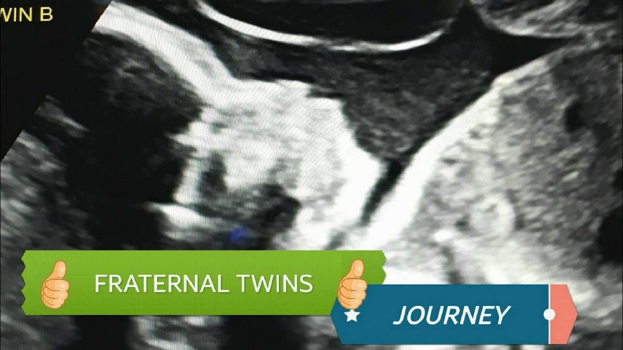 Fraternal twins 17 weeks ultrasound..😉😉😉 - YouTube