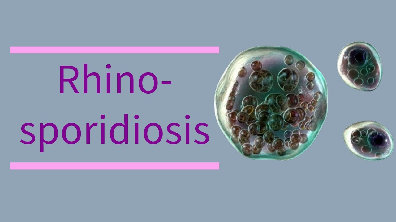 Rhinosporidiosis | clinical features | diagnosis | histopathology - YouTube